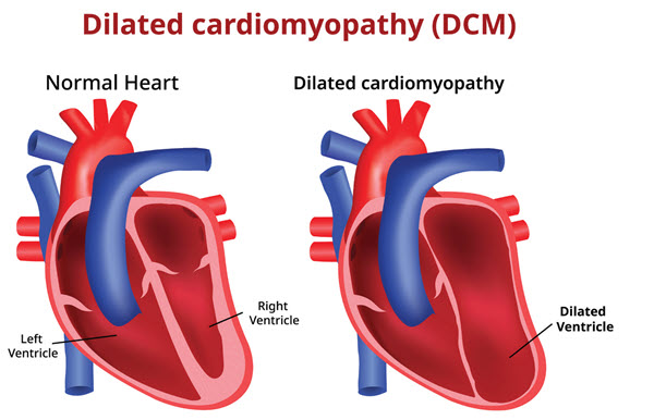 Test Your Cardiomyopathy ICD-10-CM Knowledge With a Quick Quiz : Quiz