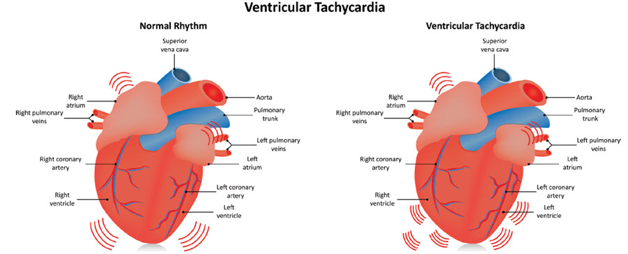 6 FAQs Guide Your Tachycardia ICD-10-CM Coding Choices : Quiz