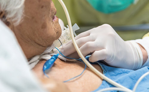 Confused About Trach Coding? Check These 3 FAQs : Tracheotomy Coding